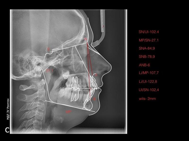 Ортодонтски анализ